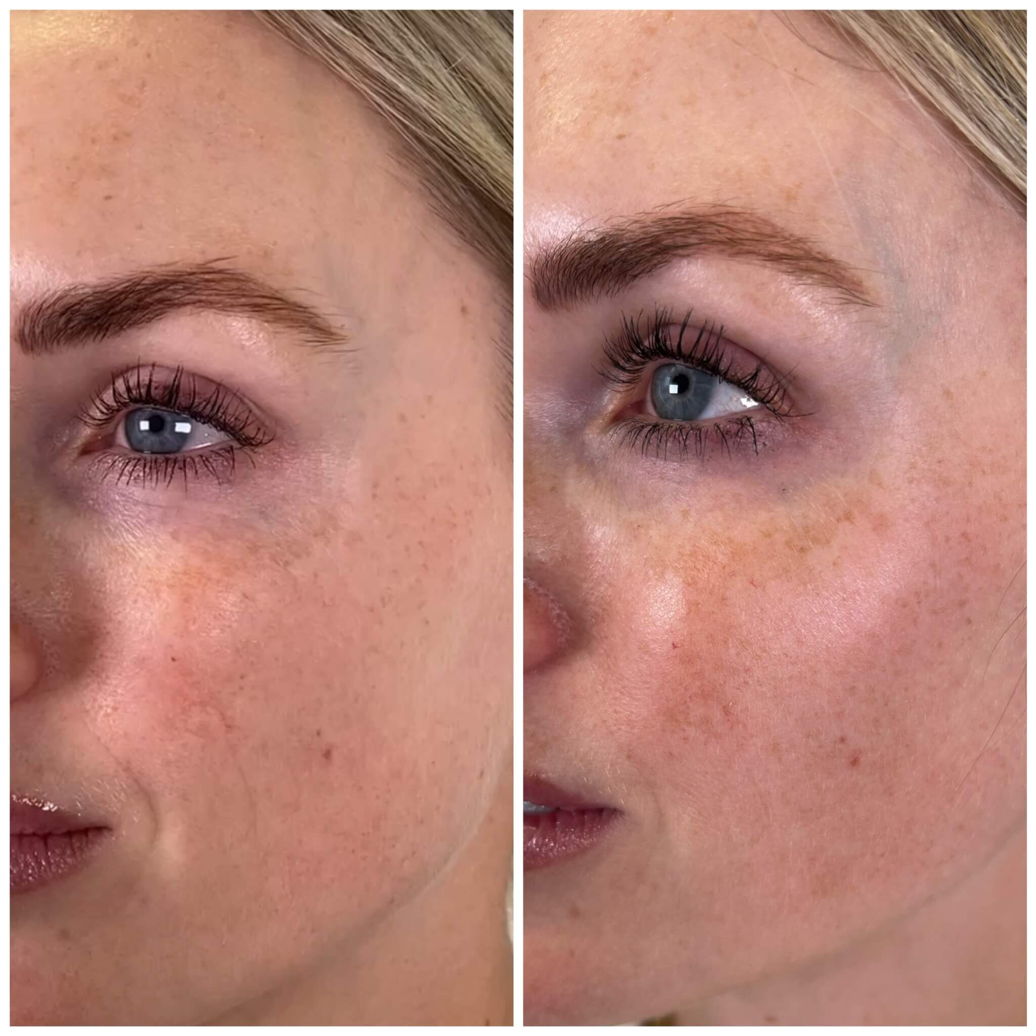 What is a Skin Booster: Unlock Youthful, Radiant Skin